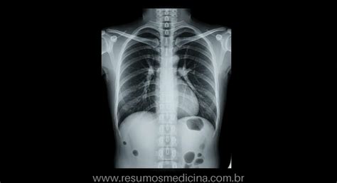 Radiografia De Tórax Guia Completo De Indicações Achados E