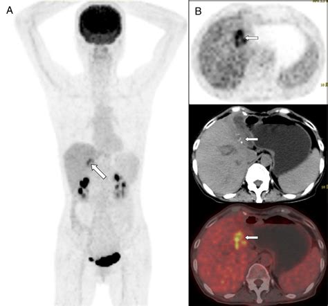 Immunoglobulin G4 Related Sclerosing Cholangitis Revealed By Clinical Nuclear Medicine