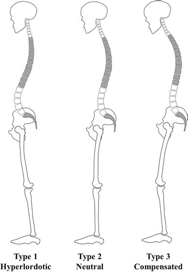 Schematic Diagram Of Three Full Body Sagittal Profile Types In Download Scientific Diagram