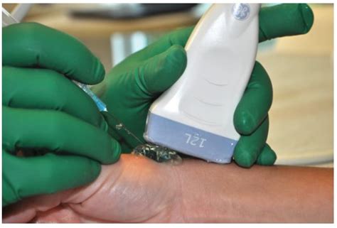 Carpometacarpal Joint Injection Wikism