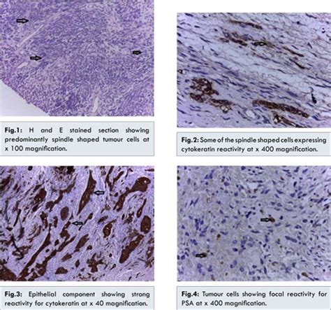 Sarcomatoid Carcinoma Of Prostate A Rare Entity