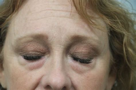 Blepharoplasty Case 3133 Dr Guy