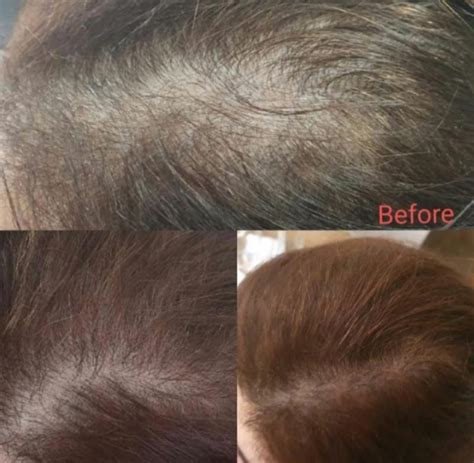 Prp Before And After Explore Possible Results Of The Treatment
