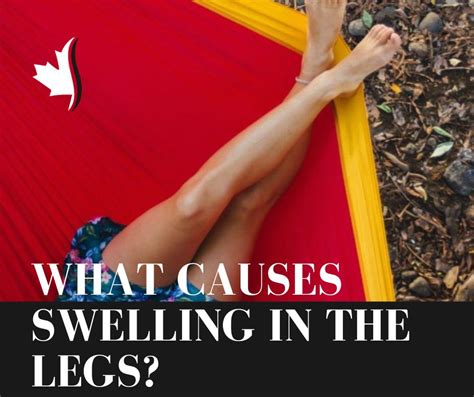 🌟 Understanding Leg Swelling What You Need To Know 🌟 Canada Vein Clinics Posted On The Topic
