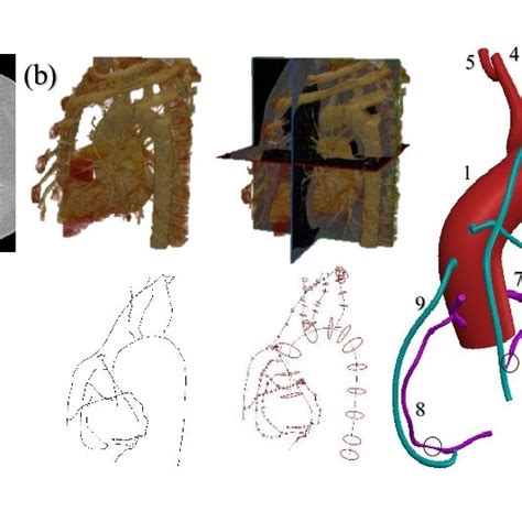 Patient Specific Geometry Reconstruction Process A Obtaining