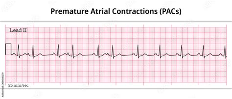 Premature Atrial Complex