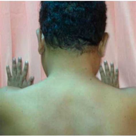 Physical Examination Of The Cervical Spine Prior To Surgery Download Scientific Diagram