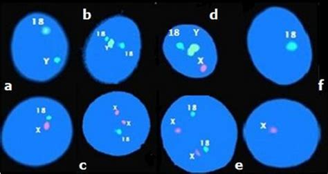 Fluorescence In Situ Hybridization With Probes For Chromosomes X Red