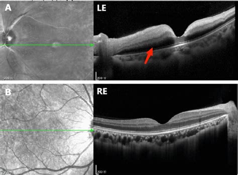 Oct Revealed Retinal Edema In Left Eye Le Arrow Point A And The