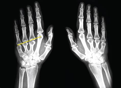Wide Spectrum Of Metacarpal Sign Three Cases Of Metacarpal Sign And
