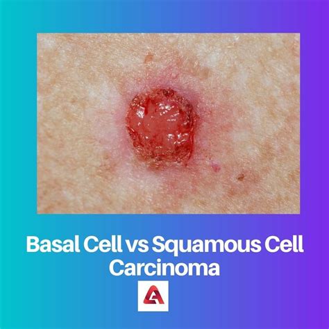 Basal Cell Carcinoma Vs Squamous At Scarlett Packham Blog