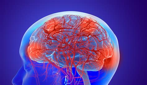 Сосудистые заболевания головного