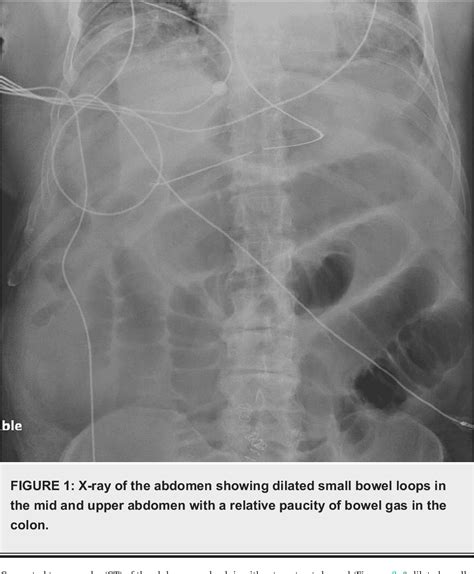 Figure 1 From Gallstone Enteropathy An Unusual Cause Of Bowel Obstruction Semantic Scholar