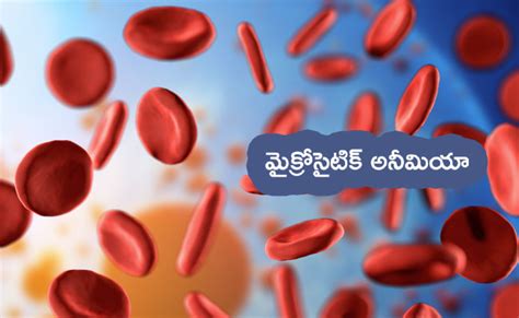 మైక్రోసైటిక్ అనీమియా అంటే ఏమిటి What Is Microcytic Anemia