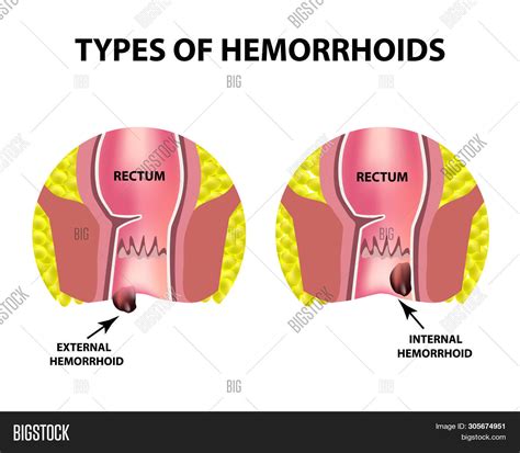 Two Types Hemorrhoids Image Photo Free Trial Bigstock
