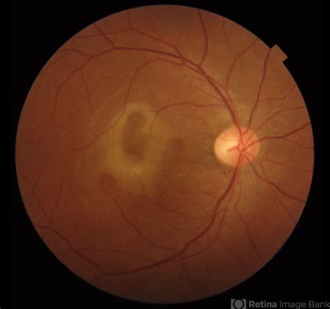 Cscr With Sub Retinal Fibrin Retina Image Bank