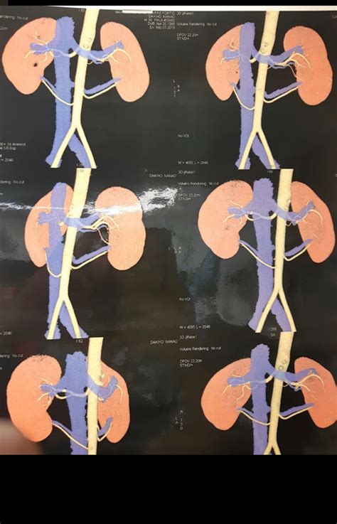 Dr Arif Akhtar On Linkedin Laparoscopic Donor Nephrectomy With Abnormal Vascular Anatomy