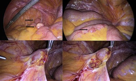 Laparoscopic Visualization Of The Multiple Peritoneal Nodules Of