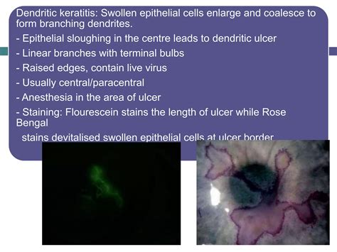 Viral Keratitis Diagnosis And Management Pptx