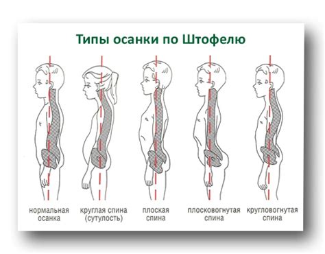 Нарушение осанки | Altmed