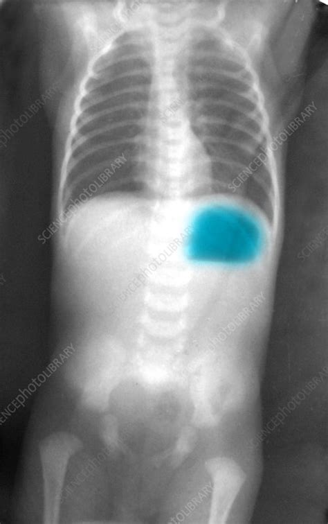 Pyloric Stenosis Abdomen X Ray Stock Image C027 2602 Science