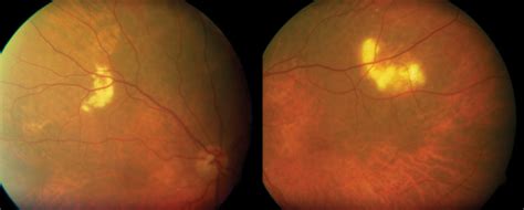 A Case Of Bilateral Idiopathic Sclerochoroidal Calcification Eye News
