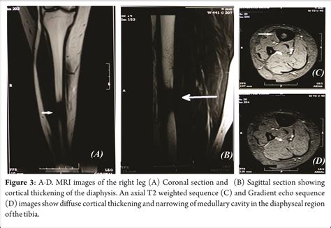 Intramedullary Osteosclerosis Of The Tibial Midshaft In A 38 Year Old Female A Case Report With