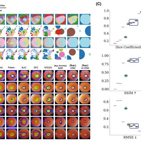 Segmenting Geographic Atrophy In Retinal Fundus Images A Download Scientific Diagram