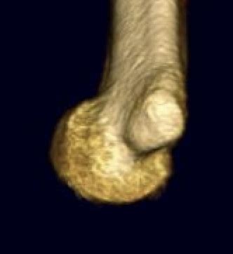 Intra Articular Distal Humerus Fractures The Bone School