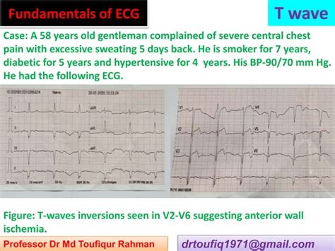 Approach To A Patient With T Wave Abnormality In Ecg Ppsx Heart And Cardiovascular Diseases