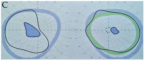 Visual Field Testing Results Showing Representative Classifications Download Scientific