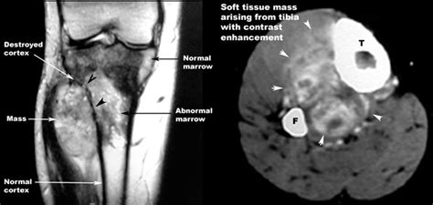 Osteogenic Sarcoma Tibia