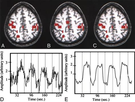 Finger Tapping Task In A Patient With A Left Temporal Glioma Ac Fmr