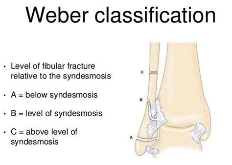 Managing An Ankle Fracture