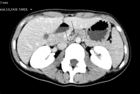 Axial Plane Of Abdominal Ct Showing Narrowing Of The Duodenum Black Download Scientific