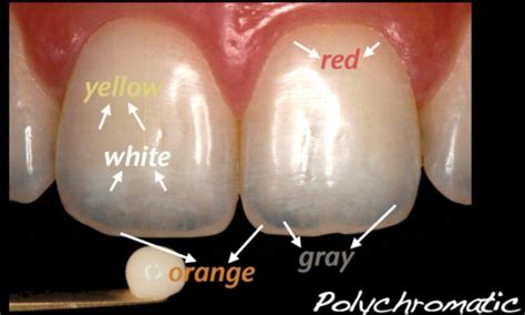 L30 Class Iv Restorations Flashcards Quizlet