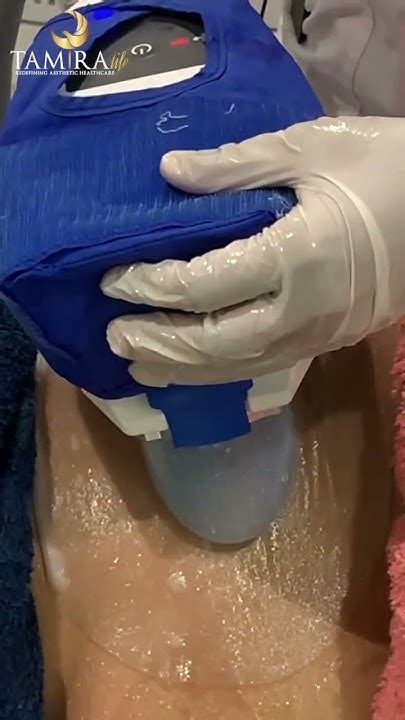 Coolsculpting Procedure What Do You Need To Know Youtube