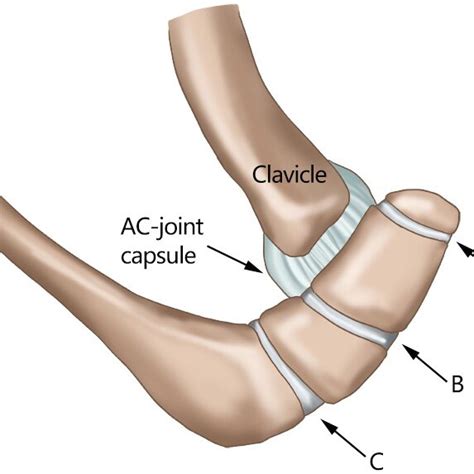 A Os Acromiale Without Step‐off Deformity T1‐weighted Sagittal Mri Download Scientific