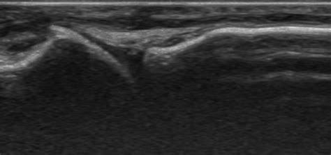 Musculoskeletal Joints And Tendons 6 8 Foot Case 6 8 3 Tendon Pathology Ultrasound Cases