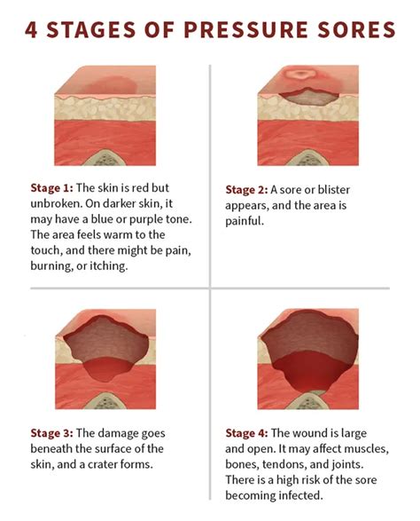 Skin Ulcer Stages Pressure Ulcersinjuries Classificationstaging