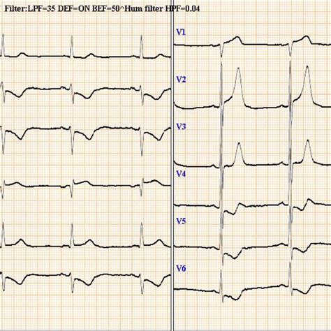 Electrocardiography Revealed St‐segment Elevation In Lead Avr With A Download Scientific