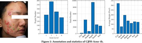 Figure 2 From Automatic Acne Classification Using Visia Semantic Scholar