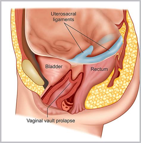 Vaginal Vault Prolapse After Hysterectomy