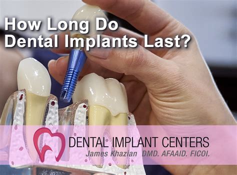 How Long Do Dental Implants Last San Diego Dental Implant Centers
