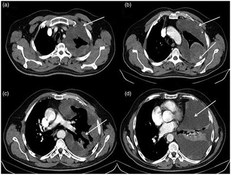 Computed Tomography Of Thorax Demonstrating A Diffuse Pleural Download Scientific Diagram