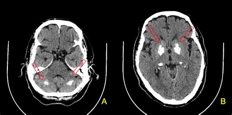 Dentate Nucleus Calcification