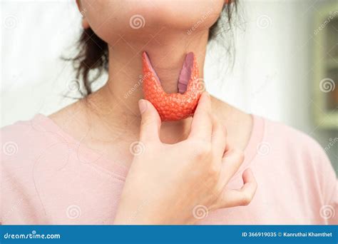 Hyperthyroidism Overactive Thyroid Thyroid Lymphoma Asian Doctor