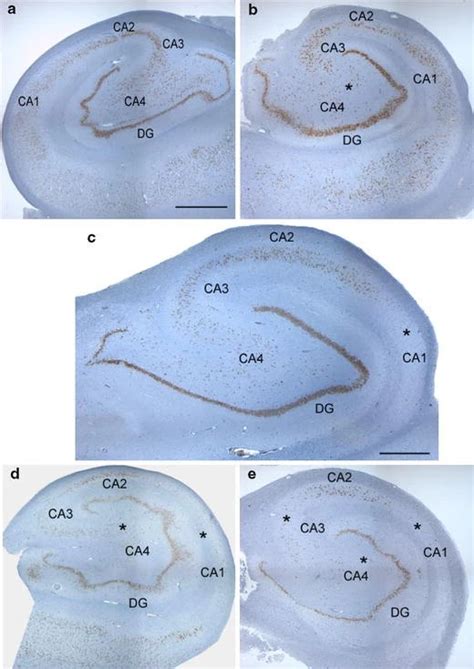Mesial Temporal Sclerosis Neuropedia