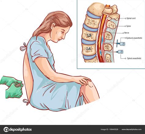 Epidural Nerve Block Injection Stock Vector Image By © 199445528