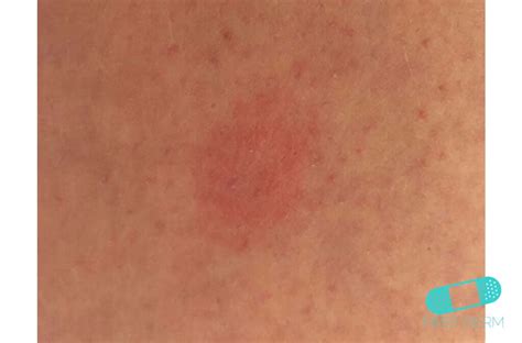 Nummular Eczema Discoid Dermatitis